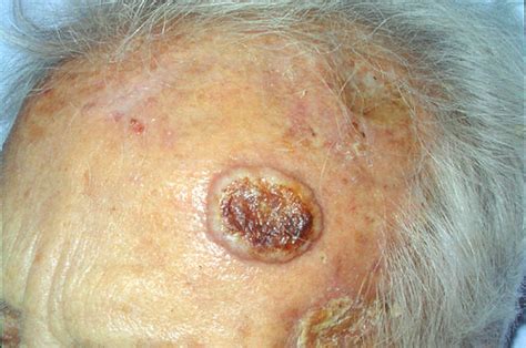 Malignant Lesions Basal Cell Carcinoma Picture Hellenic