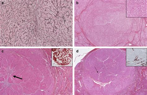 Benign Hepatocellular Nodules Reported In Vascular Liver Diseases A Download Scientific