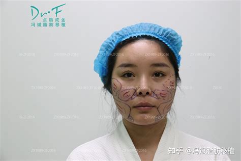 真实案例自体脂肪移植面部塑造秒变人间仙女 知乎