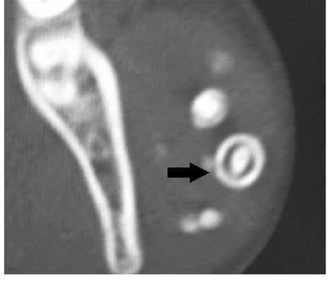 Ct Scan Of Masseteric Region Axial Showing Calcified Masses With Mild