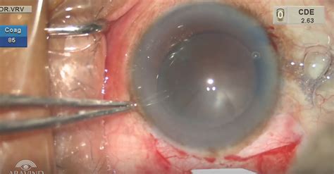 Temporal Msics In Brown Cataract Eyetube