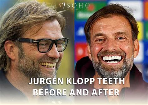 Jurgen Klopp Teeth Before And After Smile Makeover Guide