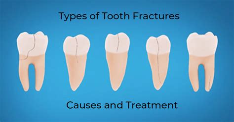 Tooth Fracture Causes And Treatment Sky Dental Care