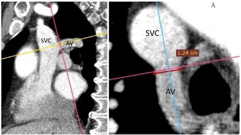 Measurement Point Of The Azygos Vein Av Diameter At The Av—svc Download Scientific Diagram
