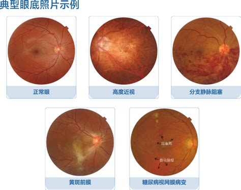 为什么建议高度近视的人都做眼底检查 知乎