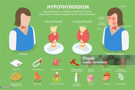 3d Isometric Flat Vector Conceptual Illustration Of Hypothyroidism