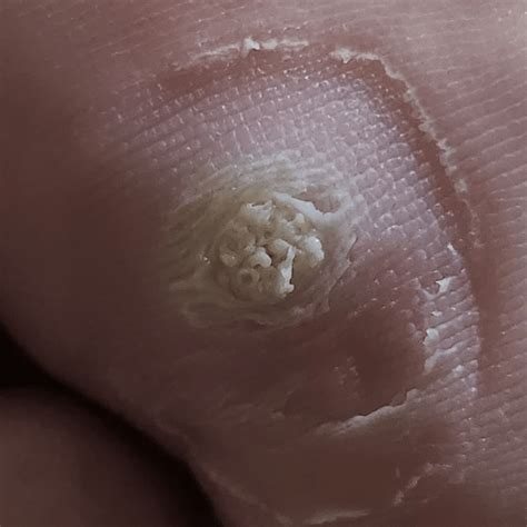 Sa Duct Tape Plantar Wart That Looks Like A Brain Rwarts