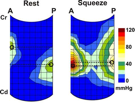 Figure 5 From Dynamic Assessment Of The Vaginal High Pressure Zone Using High Definition