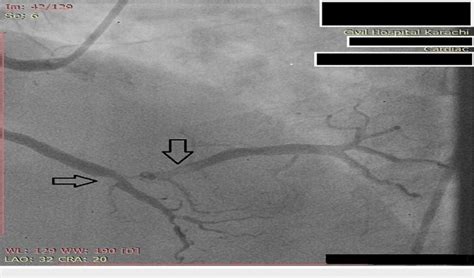Angiogram Of Rca Showing Severe 80 90 Blockage With Complete