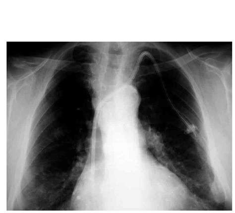 Chest X Ray Showing The Correct Position Of An Ash Split
