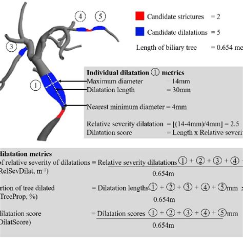 Biliary Tree Model Demonstrating Candidate Strictures And Dilatations Download Scientific