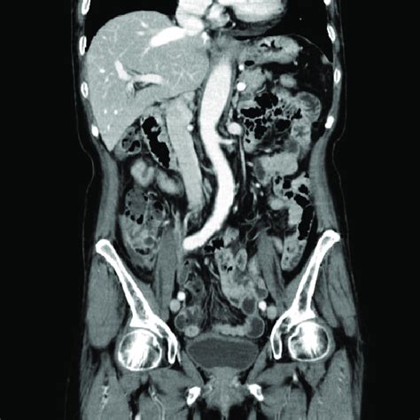 Coronal Reconstructed Computed Tomography Scan With Intravenous