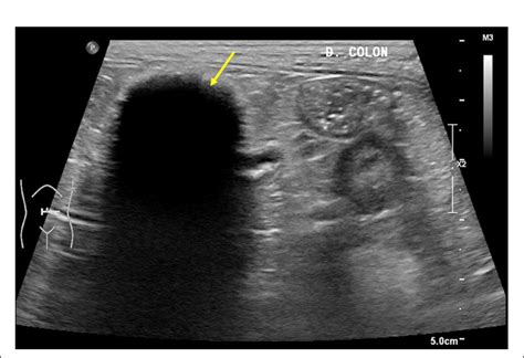 FIGURE Transverse Ultrasonographic View Of The Mass Like Structure At
