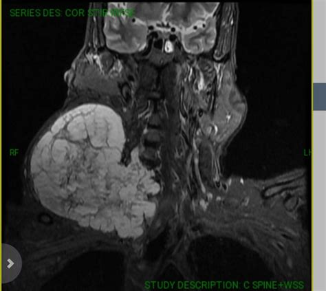 Ct Showing Mass Arising From Cervical Spine Download Scientific Diagram