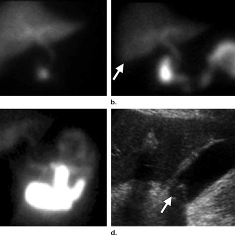 Biliary Leak From The Cystic Duct Stump In A 63 Year Old Woman With