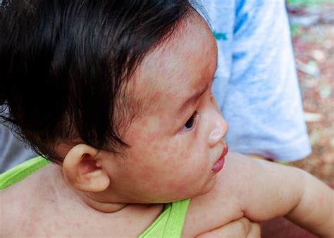 Sarampo Saiba Como Proteger O Seu Filho Hospital Sabará