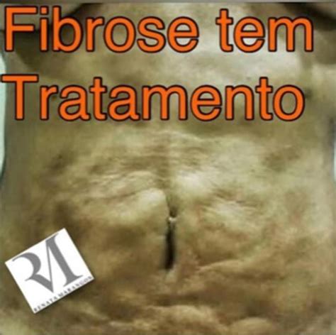 Fisioterapia Em Pós Operatório De Cirurgias Plásticas Fibrose Tem