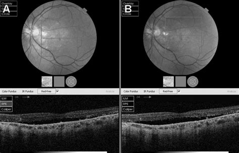 A Left Eye Showing Poor Response Post Pdt At 4 Months B Left Eye