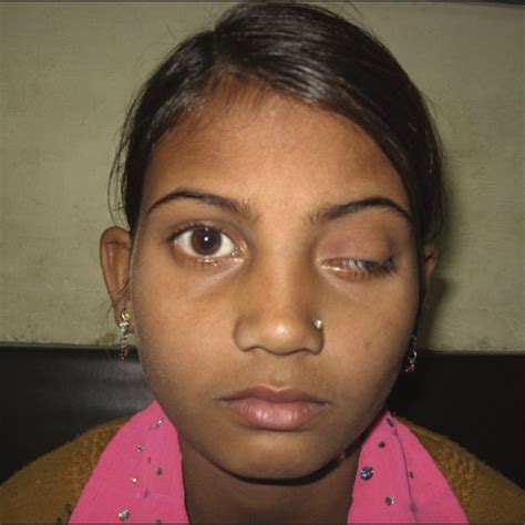 Complete Third Nerve Palsy With Pupillary Involvement In The Left Eye