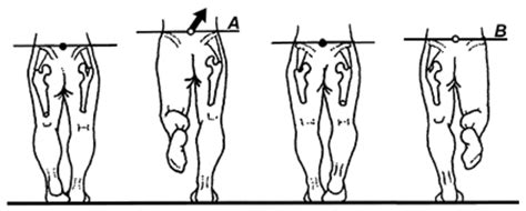 Managing Limb Length Discrepancies Human Locomotion