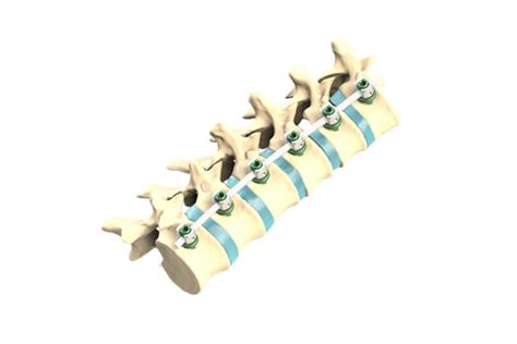 Correction Cord Tria Spine Ankara Turkey