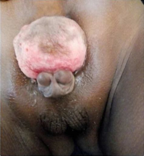 Image Showing The Posterior Bladder Wall With A Bifid Penis Typical Of Download Scientific