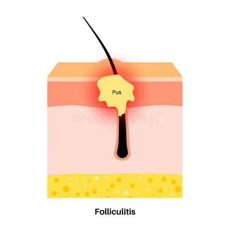 Folliculitis In Skin Layers Stock Vector Illustration Of Disease