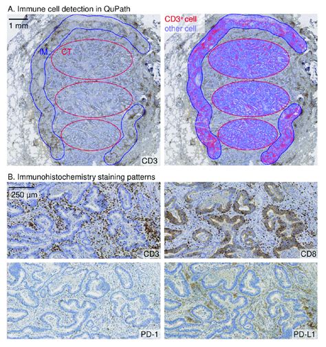 Immune Cell Density Analysis And Immunohistochemistry Staining Patterns Download Scientific