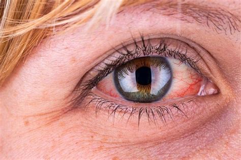 Red Eyes Causes Treatment And Tips Womens Alphabet