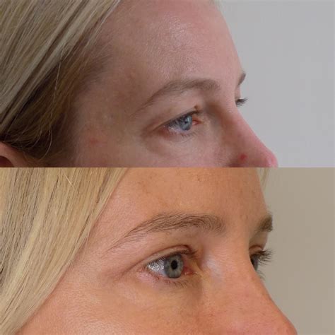 Blepharoplasty Dr Fiumara 5 Natural Results