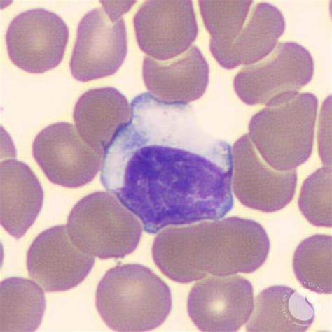 Reactive Lymphocyte