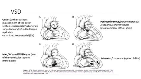 Atrial Septal Defects Ventricular Septal Defects Assessment
