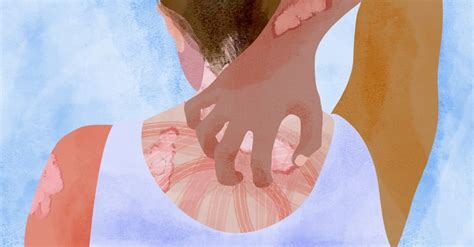 Pruritus The Itch That Wont Stop And How It Relates To Psoriasis
