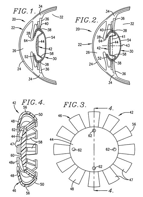 Intraocular Lens Implant Patented Technology Retrieval Search Results