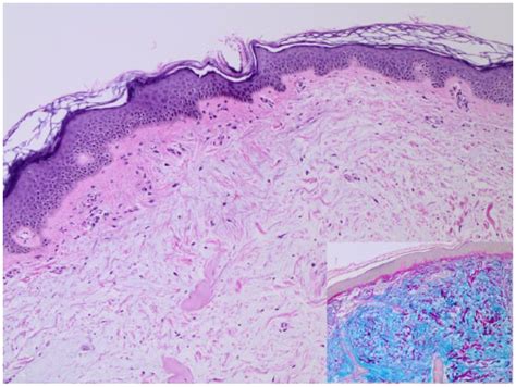 Scleromyxedema Histology
