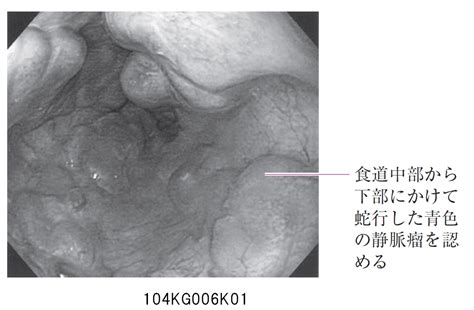 104G6 食道胃静脈瘤 国試 M3E Medical