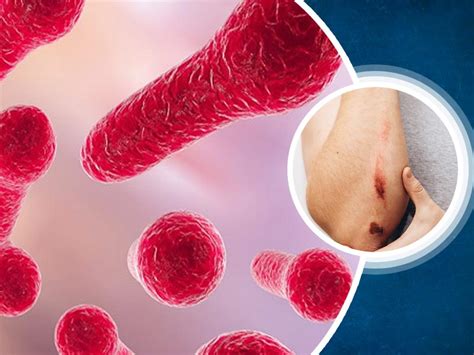 Tetanus Infection Know Its Various Symptoms Causes And Treatment