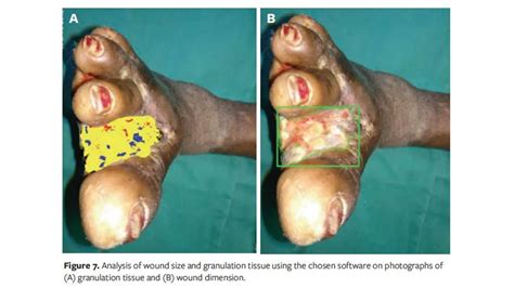 Ultrathin Graft In Threatment Of Doabetic Foot Ulcerpptppt Free Download
