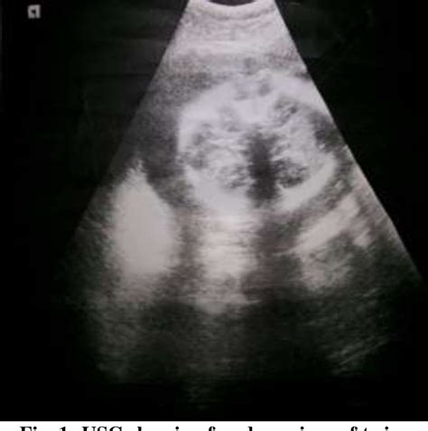 Figure 4 From Cephalothoracopagus Janiceps Conjoined Twins A Rare Case Semantic Scholar