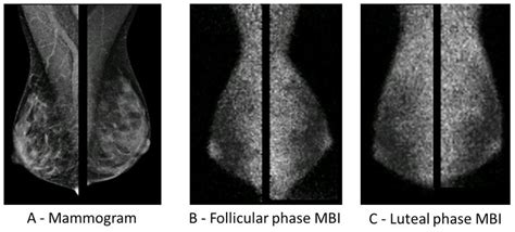 Mammography And Mbi Performed In A 41 Year Old Premenopausal Woman