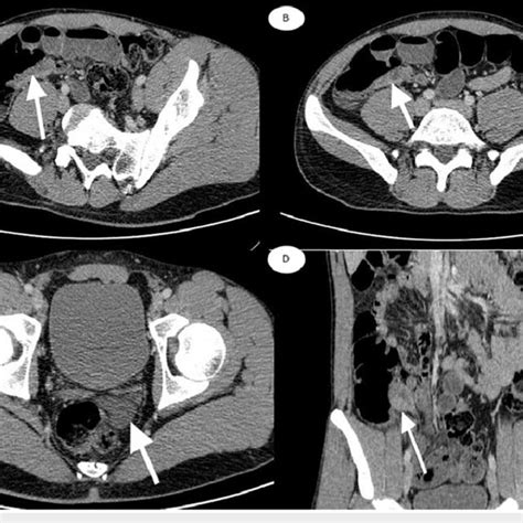 Contrast Ct Scans Of The Abdomen And Pelvis A Paracecal Inflammatory