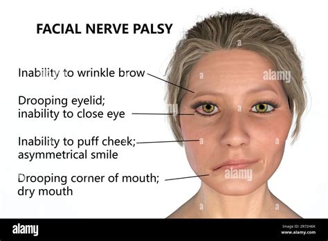 Bells Palsy A Unilateral Facial Paralysis Computer Illustration The