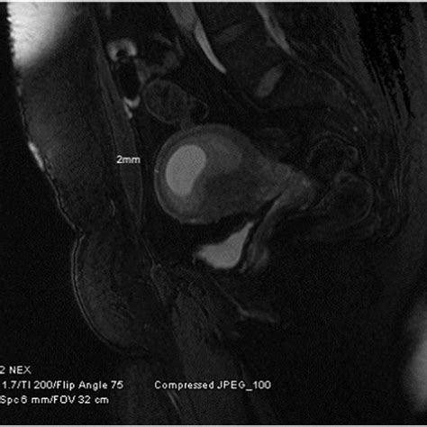 Laparoscopic View Of Cornuostomy Incision In Right Interstitial Ectopic