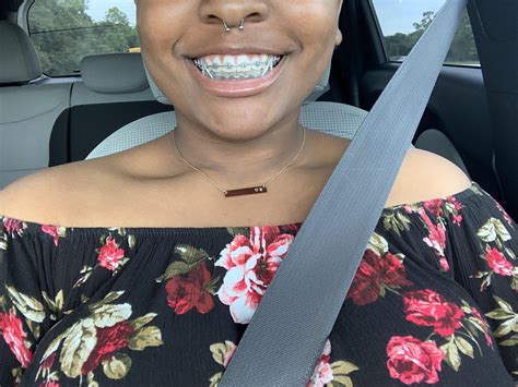Orthodontist Said My Braces Will Be Coming Off Soon Im Not Sure If I