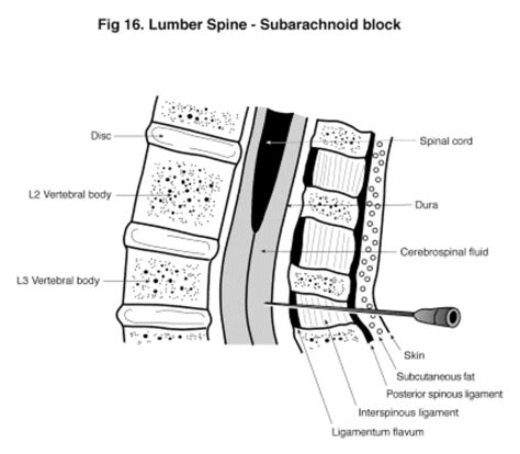 Subarachnoid Block Also Known As Spinal Block Wfsa Resources