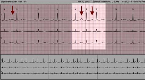Premature Atrial Contractions Ecg