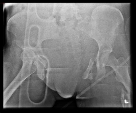 Pelvic Ring Fractures Trauma Orthobullets