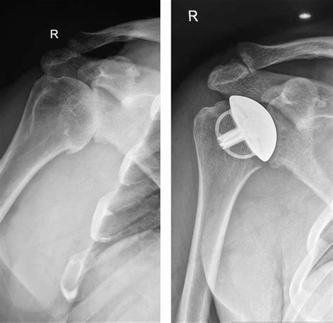 Stemless Mexicoshoulder Mexicoelbow Mexicoknee