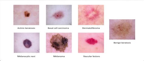 Examples Of The Ham10000 Dataset Download Scientific Diagram