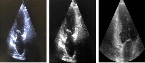 Cardiac Phase Detection In Echocardiography Using Convolutional Neural Networks Scientific